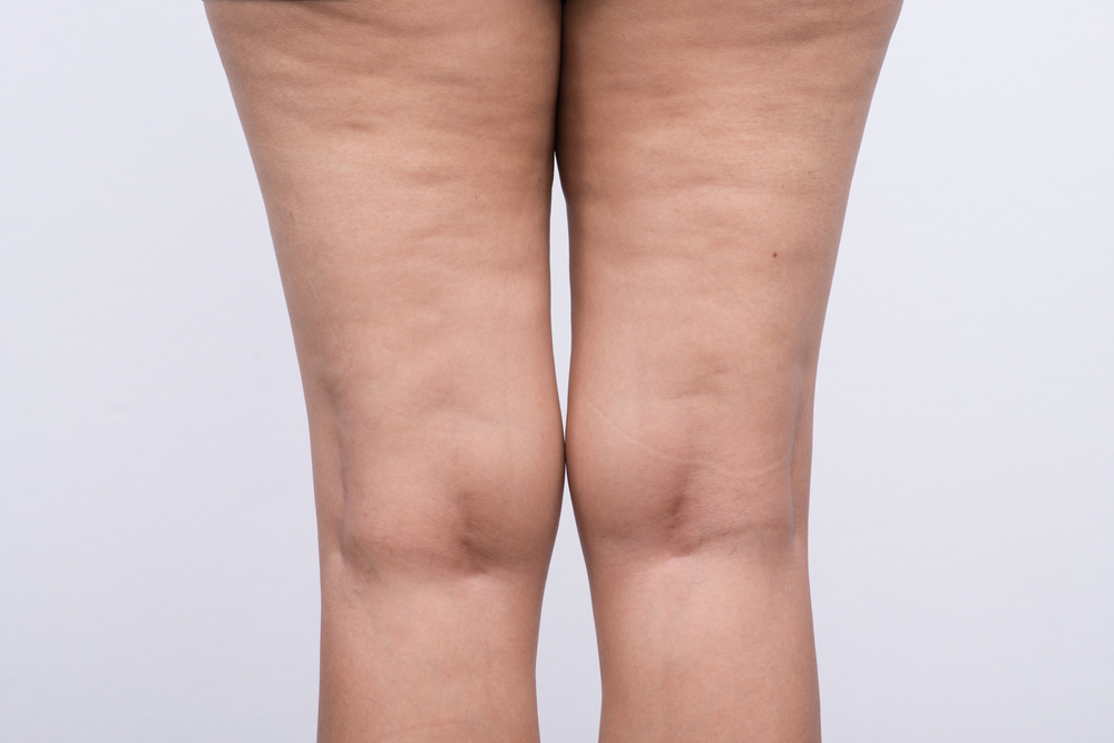 Could The Presence Of Cellulite Indicate Disease Your Total Health